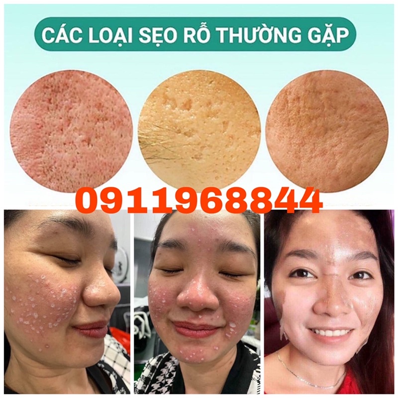 Tca50 Break Down The Bottom Cut Fill Pitting Scars Clear Acne Freckles Uneven Skin Color