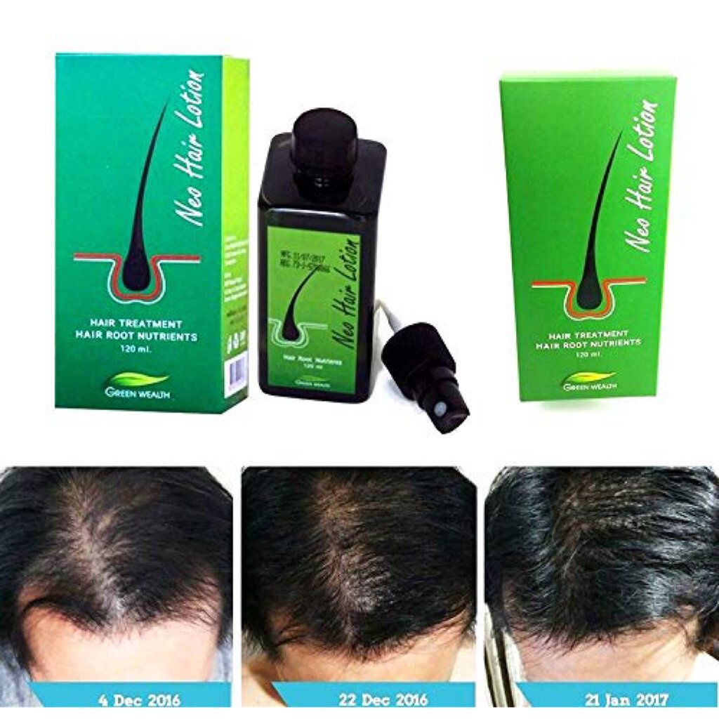 2 Box Original Neo Hair Lotion / Neo Hair Oil Anti-Hair Loss Hair Tonic ...