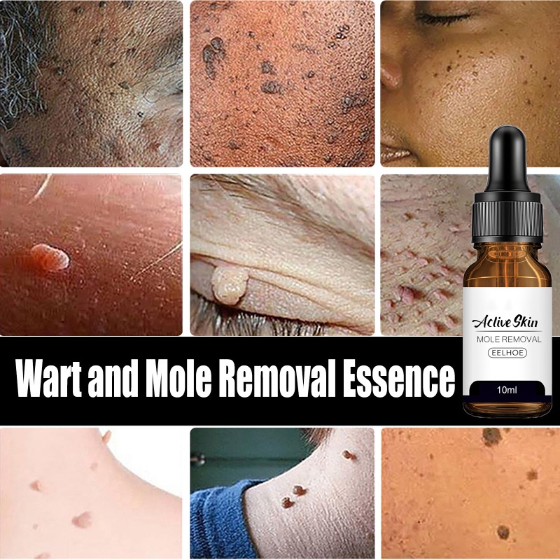 Eelhoe Wart Removal Essence Treatment Neck Skin Tag Armpit Flat Wart ...