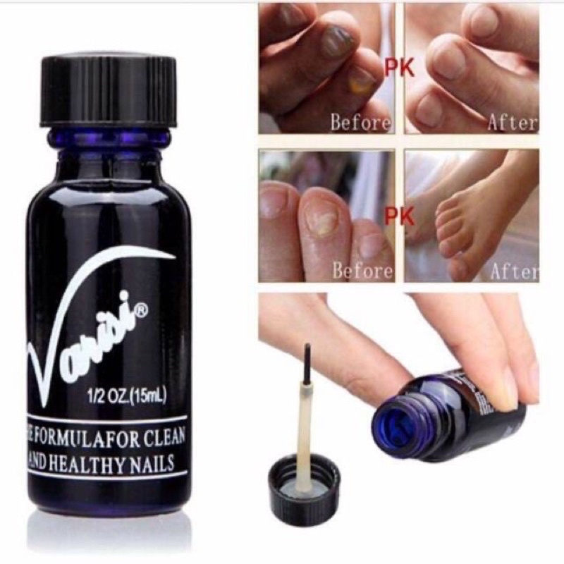 Varisi anti-fungal HandPiece, fungus FootPiece | Shopee Singapore