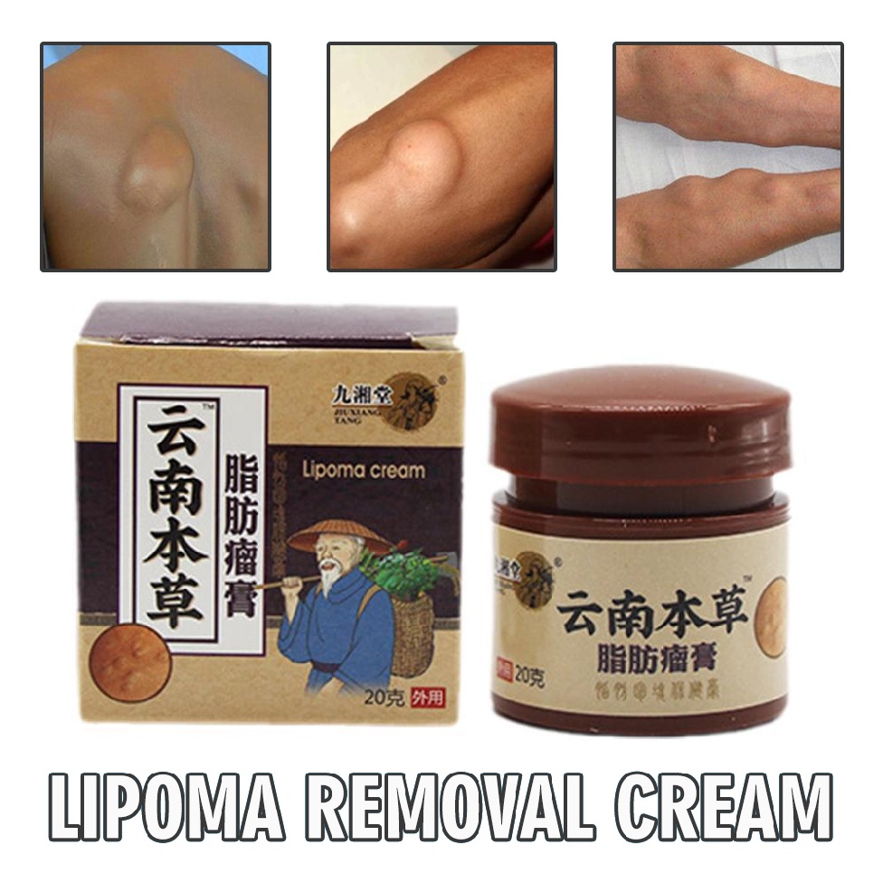 20g Lipoma Removal Cream Treat Tumor Skin Swelling Ointment Herbal ...