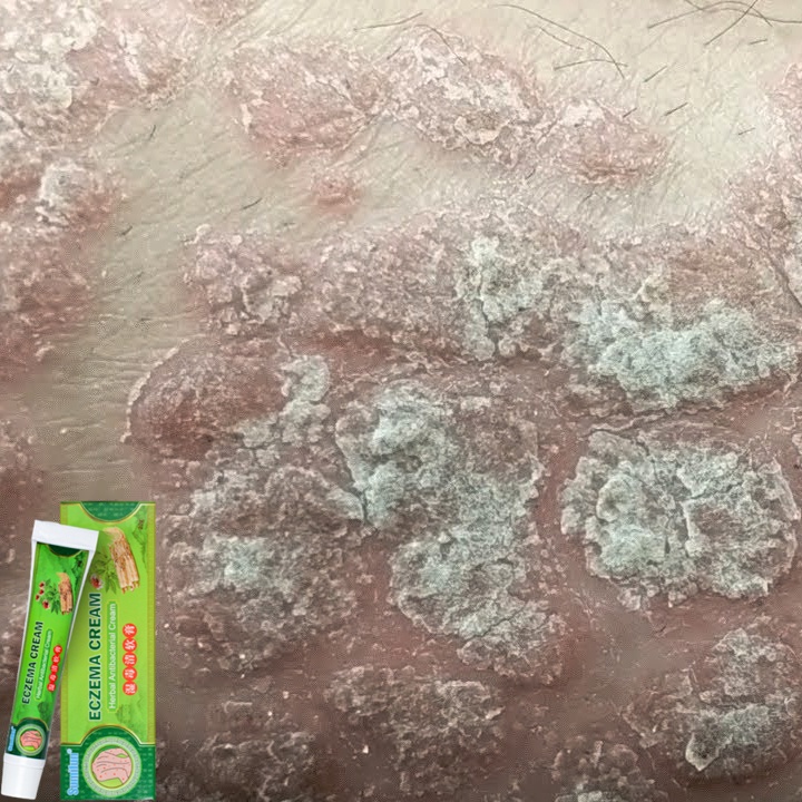 Eczema Cream Ubat Gatal Krim Psoriasis Cream krim gatal Eczema ...