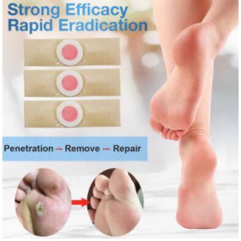 HITAM Corn PLASTER remover 6Pcs skin tag remover moles remover warts ...