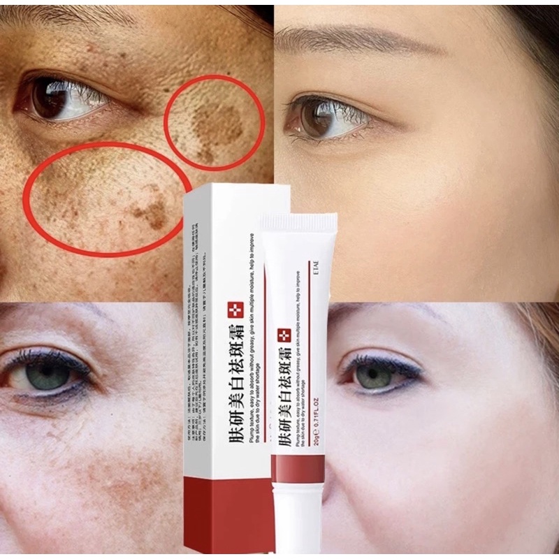 Effective Dark Spot and Hyperpigmentation Reduction Cream - Fades Acne ...