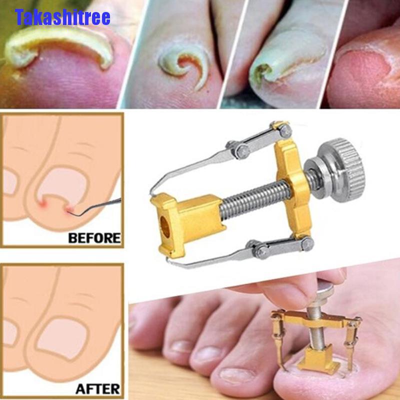 Takashitree Ingrown Toenail Toe Fixer Recover Correction Device ...