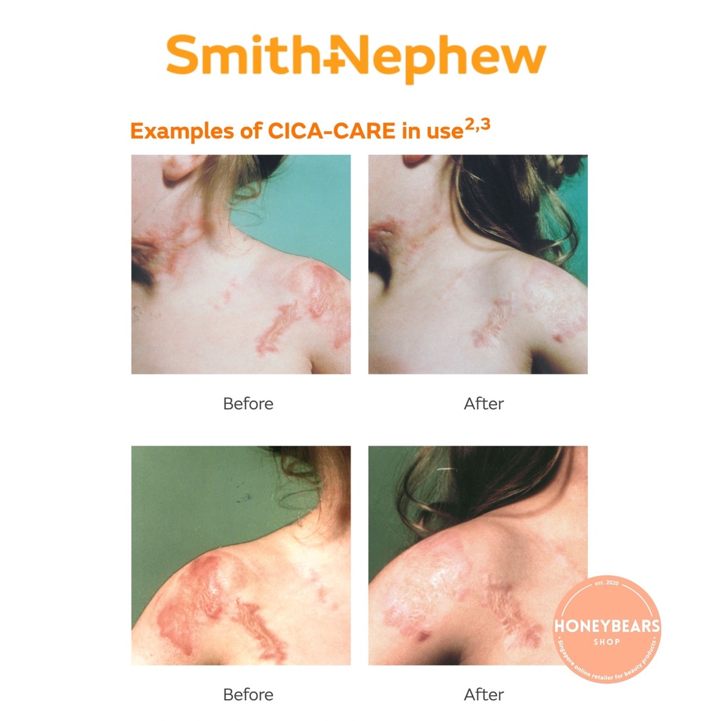 CICA-CARE Self-Adhesive Silicone Gel Sheet | Hypertrophic/Keloid Scar ...