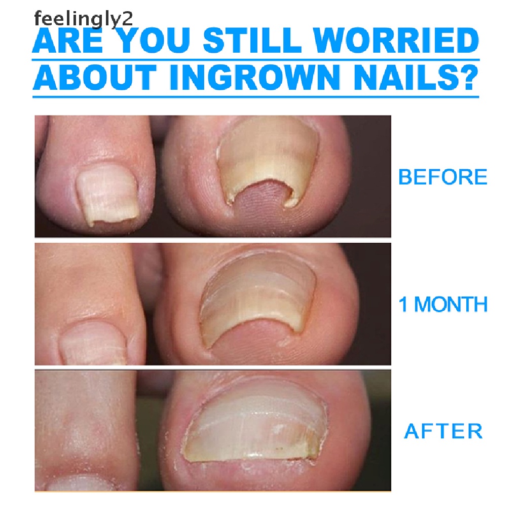 [feel] 60Pcs Nail Art Ingrown Correction Sticker FixerParonychia ...