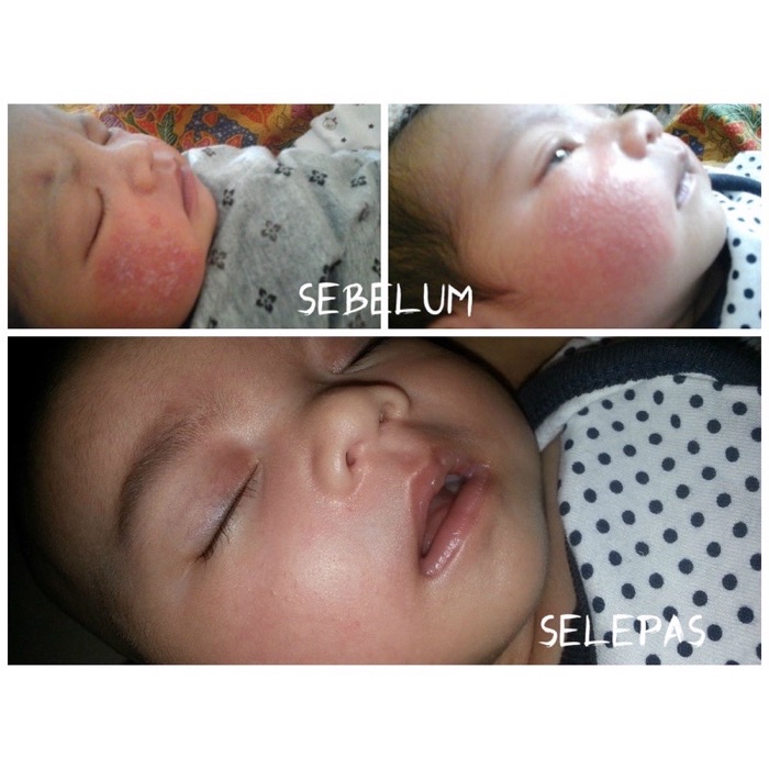 MERAH Ekzema Psoriasis Itchy Skin Red Spots Milk Rash Diaper Rash ...