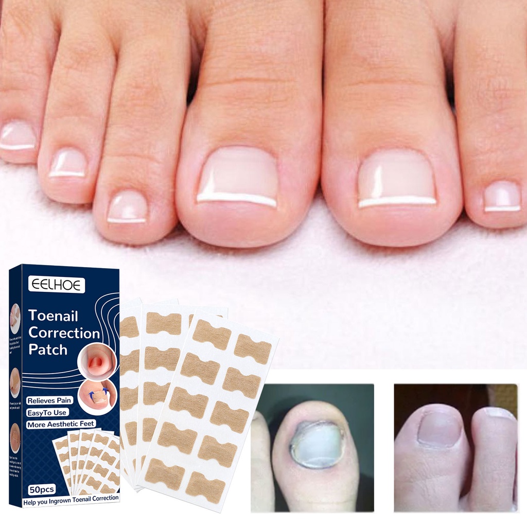 50pcs Nail Correction Stickers Ingrown Toenail Corrector Patches ...
