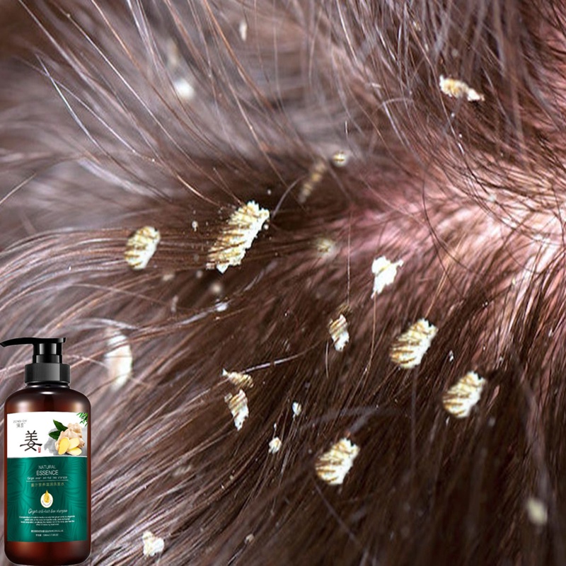 Dandruff medicine Dandruff Shampoo hair treatment Dandruff dry itchy ...