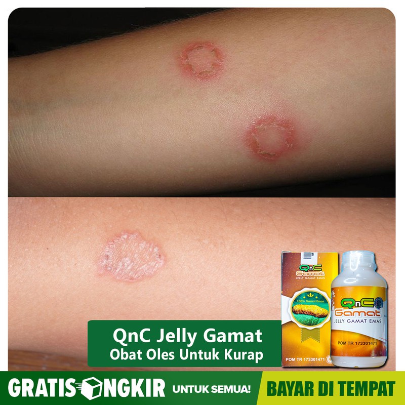 Special Medicine for Ringworm Panu Itching Eczema Fungus Scabies Rashes ...