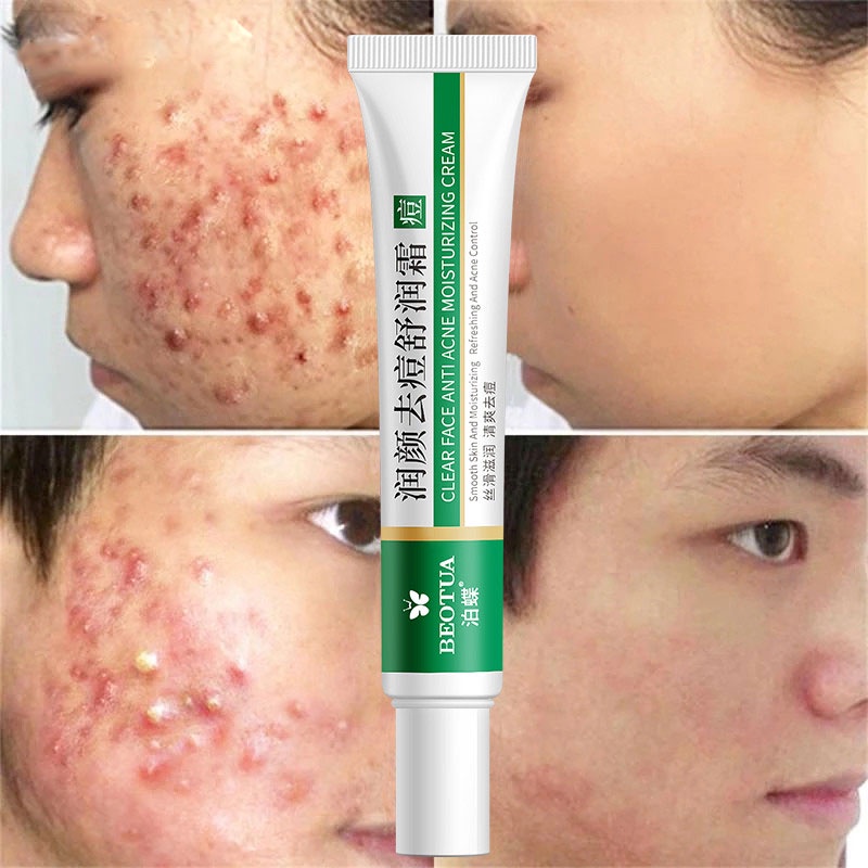Effective Acne Removal Cream Herbal Acne Spots Oil Control Acne Cream ...