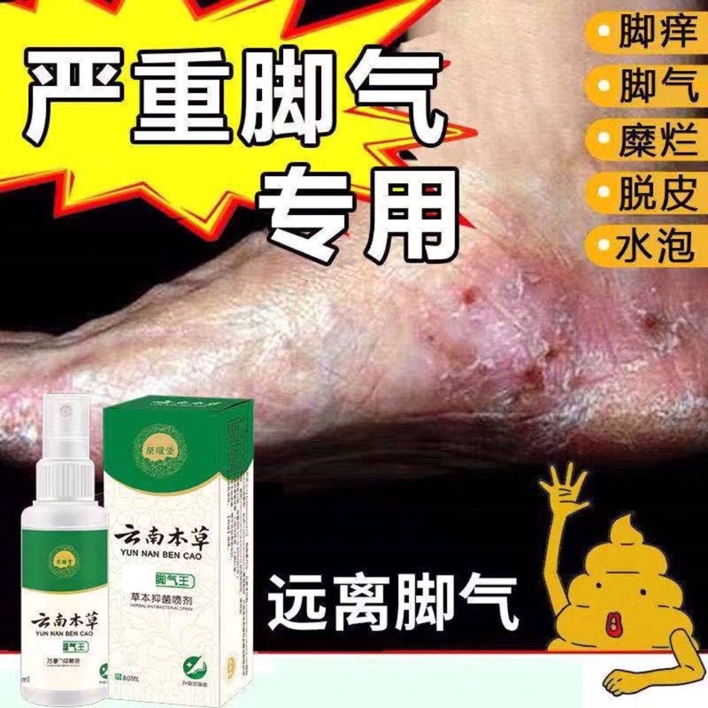 Spray YUNNAN ANTI BACTERIAL SKIN FUNGUS Treat Ringworm Scabies Eczema ...