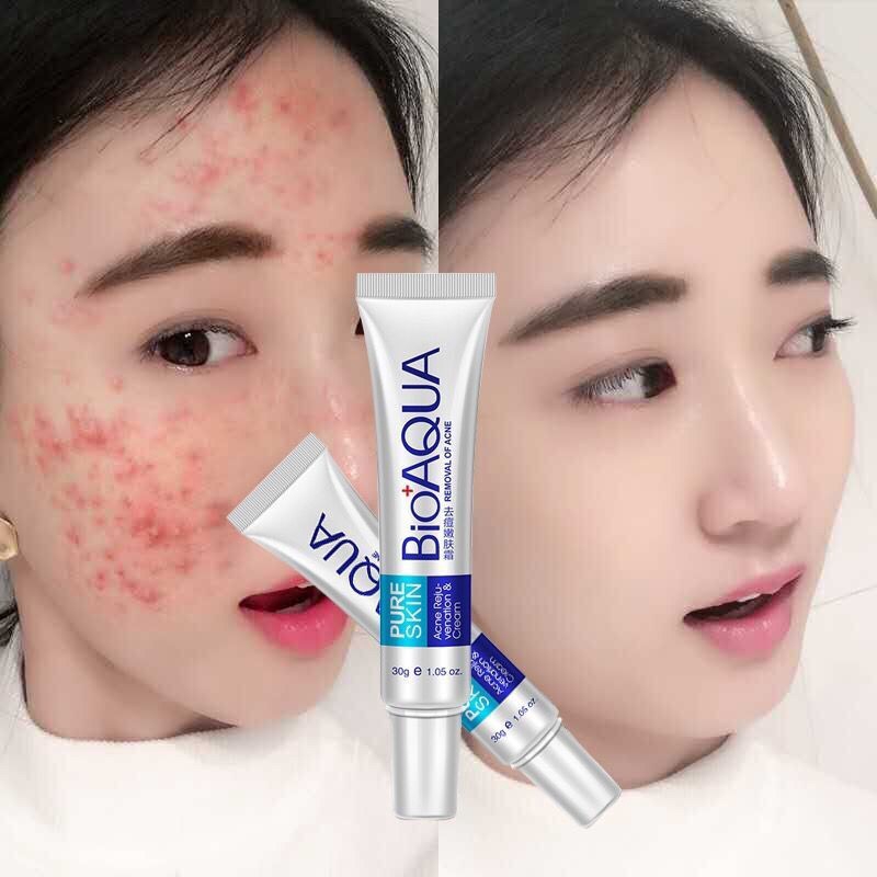 BIOAQUA acne cream anti Acne face cream skin care | Shopee Singapore