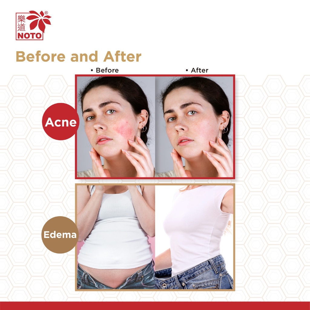 NOTO Dampness Health Capsules Supplement for Resolving Damp-toxin ...