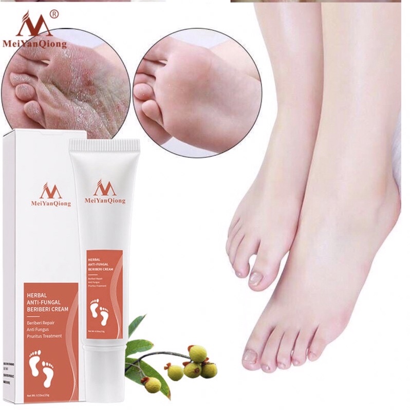 Natural Herbal Anti-Fungal Treatment Cream for Foot and Nail Infections ...