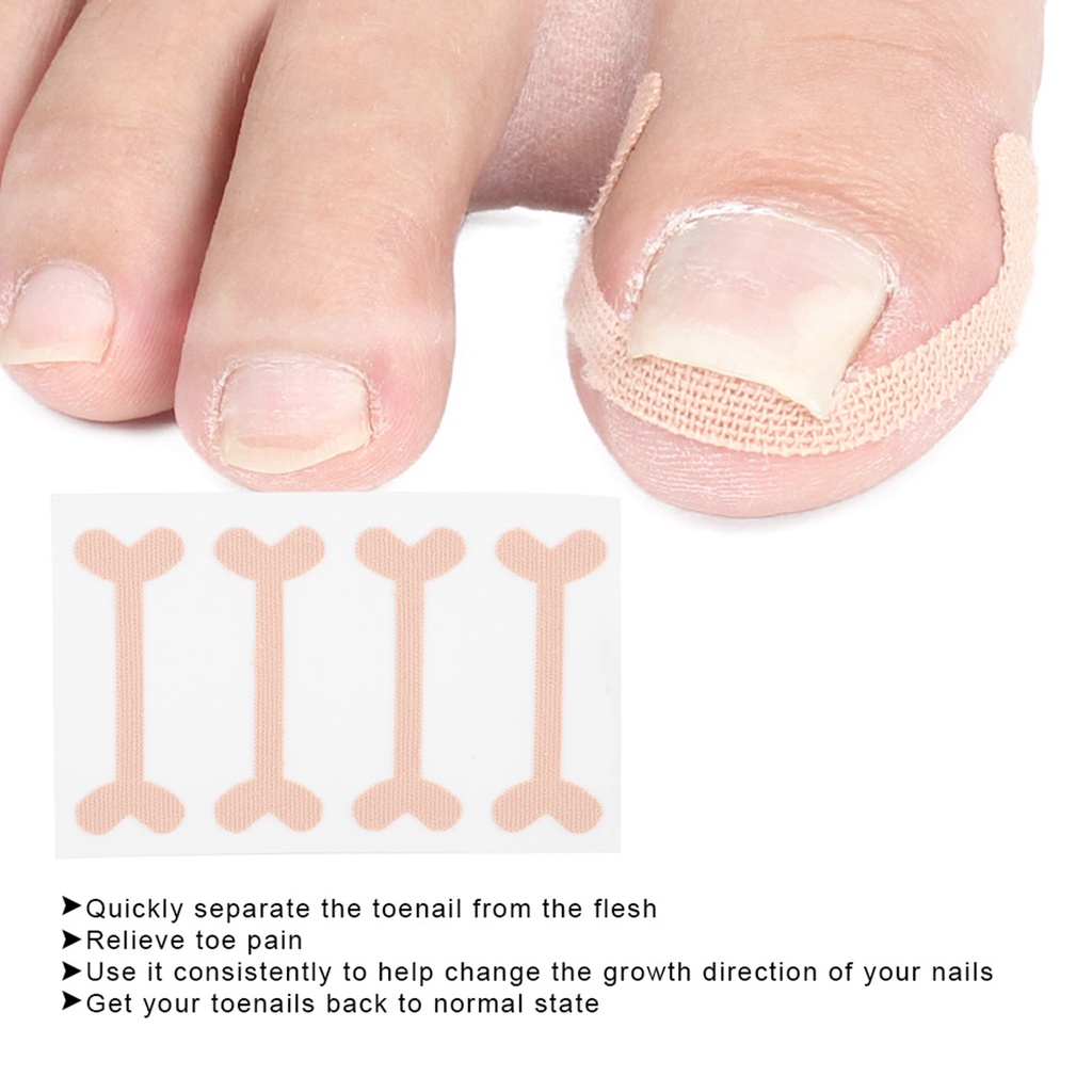 Keaostore 24pcs Ingrown Toenail Correction Bandage Pain Relief ...
