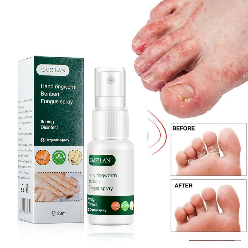 Anti Fungal Infection Onychomycosis Paronychia Spray Herbal Foot ...