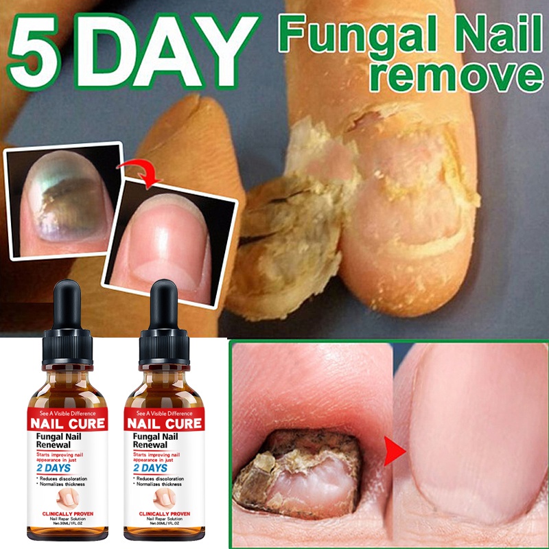 Nail fungus treatment liquid can treat nail infection and help nail ...