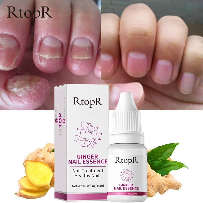 RtopR Ginger Antibacterial Nail Treatment Serum Essential Onychomycosis ...