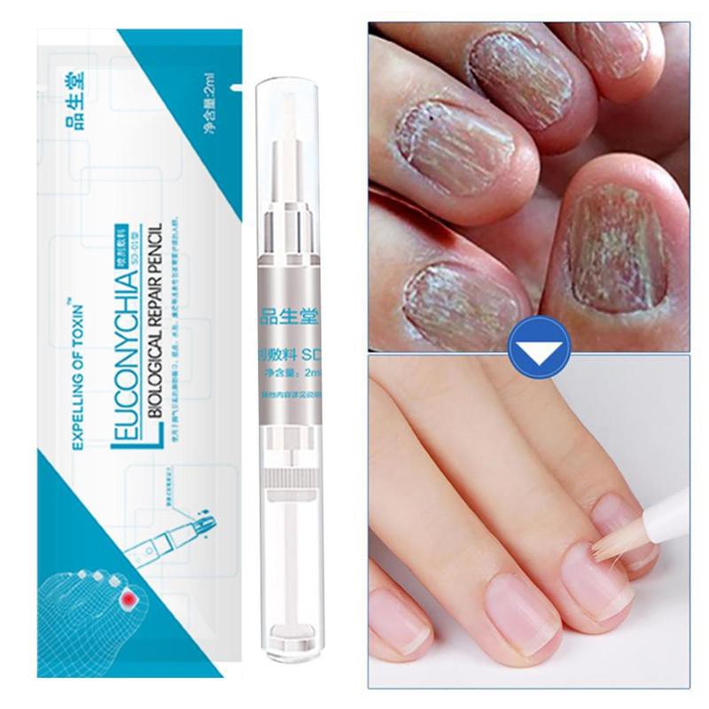 Nail Fungus Treatment Nail Oil Pen Anti Fungal Nail Infection Cuticle ...