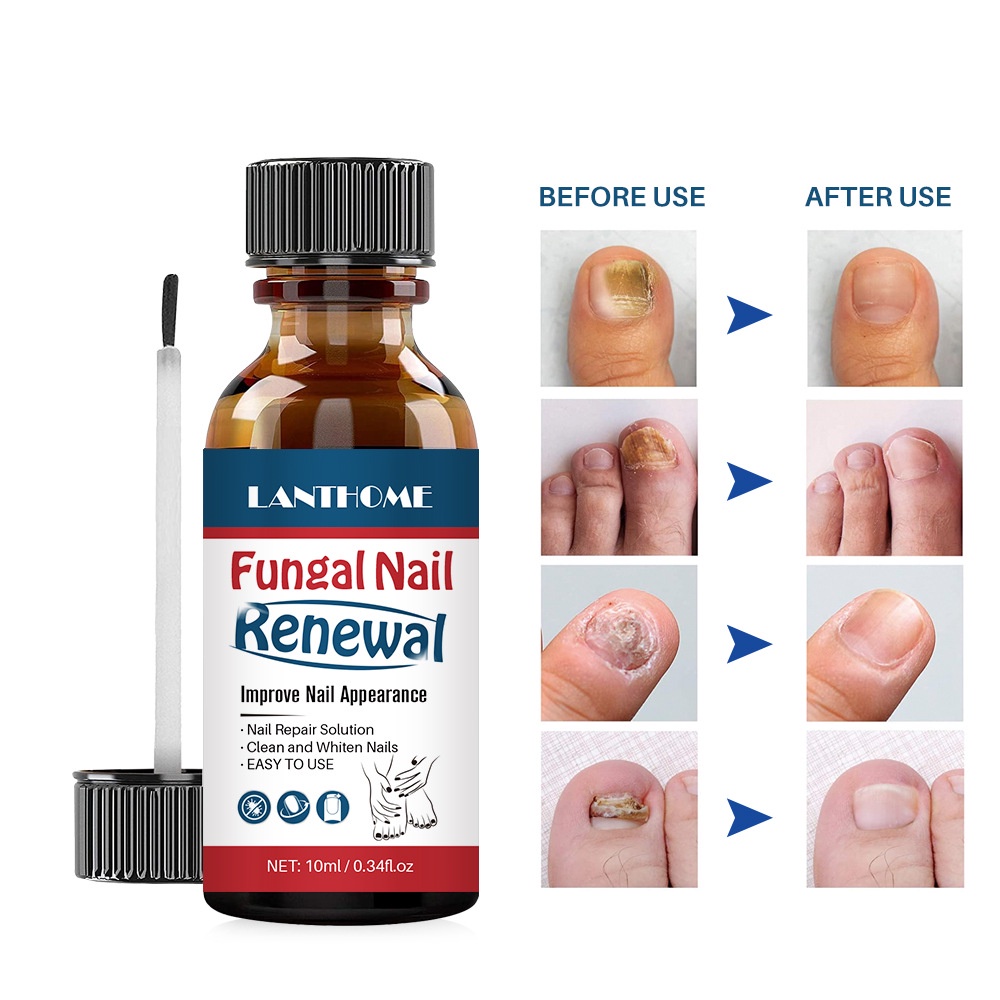 Lanthome Herbal Fungal Nail Renewal For Nail Repair And Whitening ...