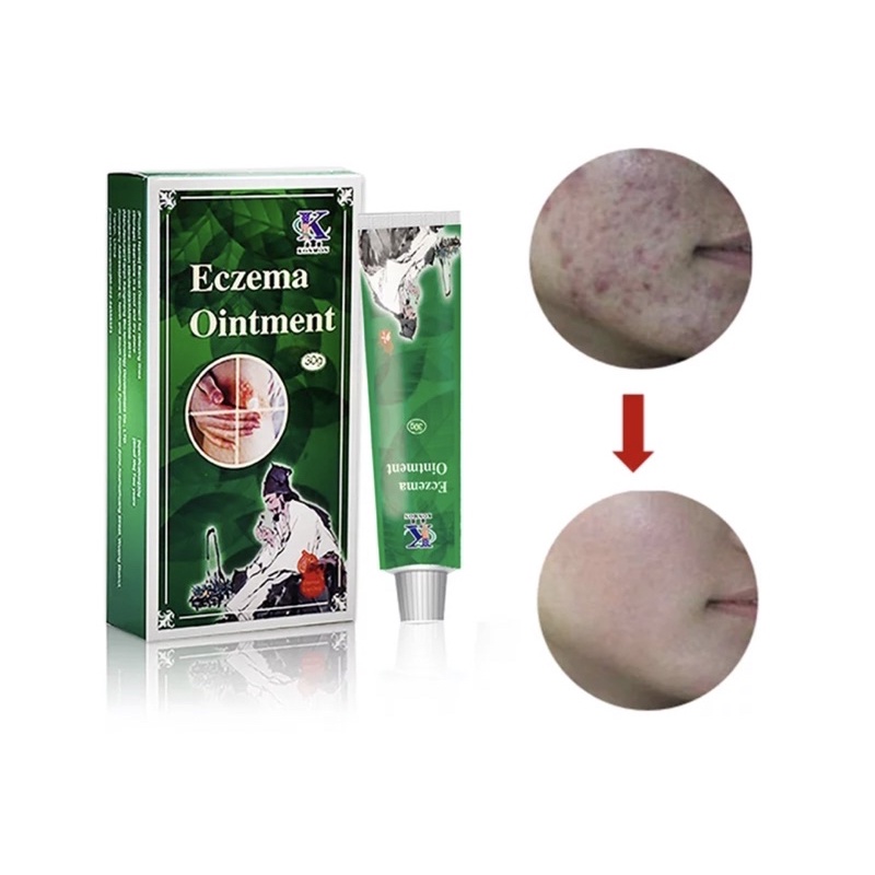 Herbal Anti Itch Cream For Eczema And Psoriasis 100 Natural Treatment