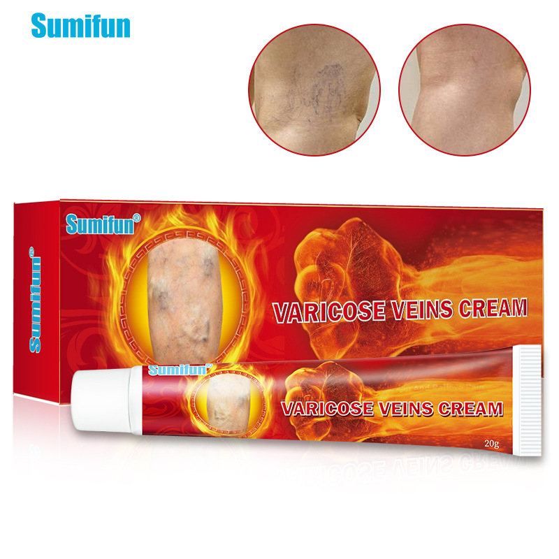 Varicose Vein Spray Repair leg blood vessels bulge swelling earthworm ...