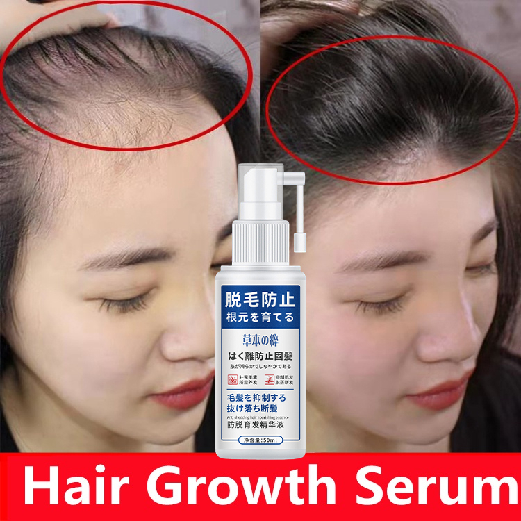 [fast Effective]hair Growth Serum Anti Hair Loss Prevention Prevents