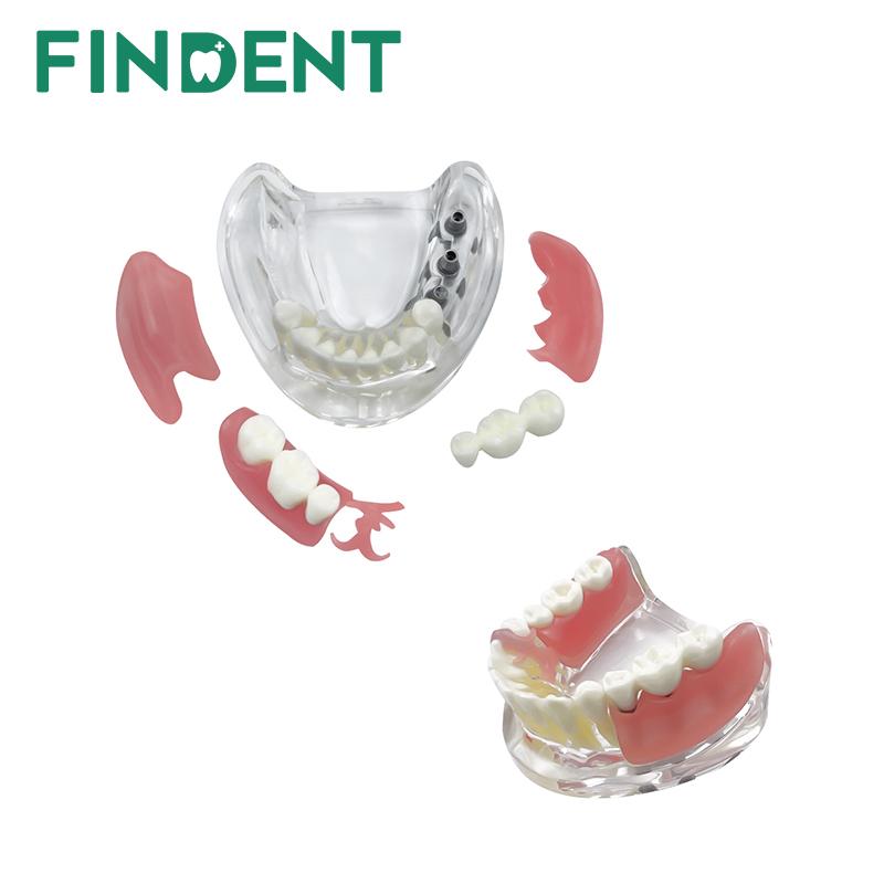 Lower Jaw Teeth Model Removable With Implant Bridge Restoration Dental ...