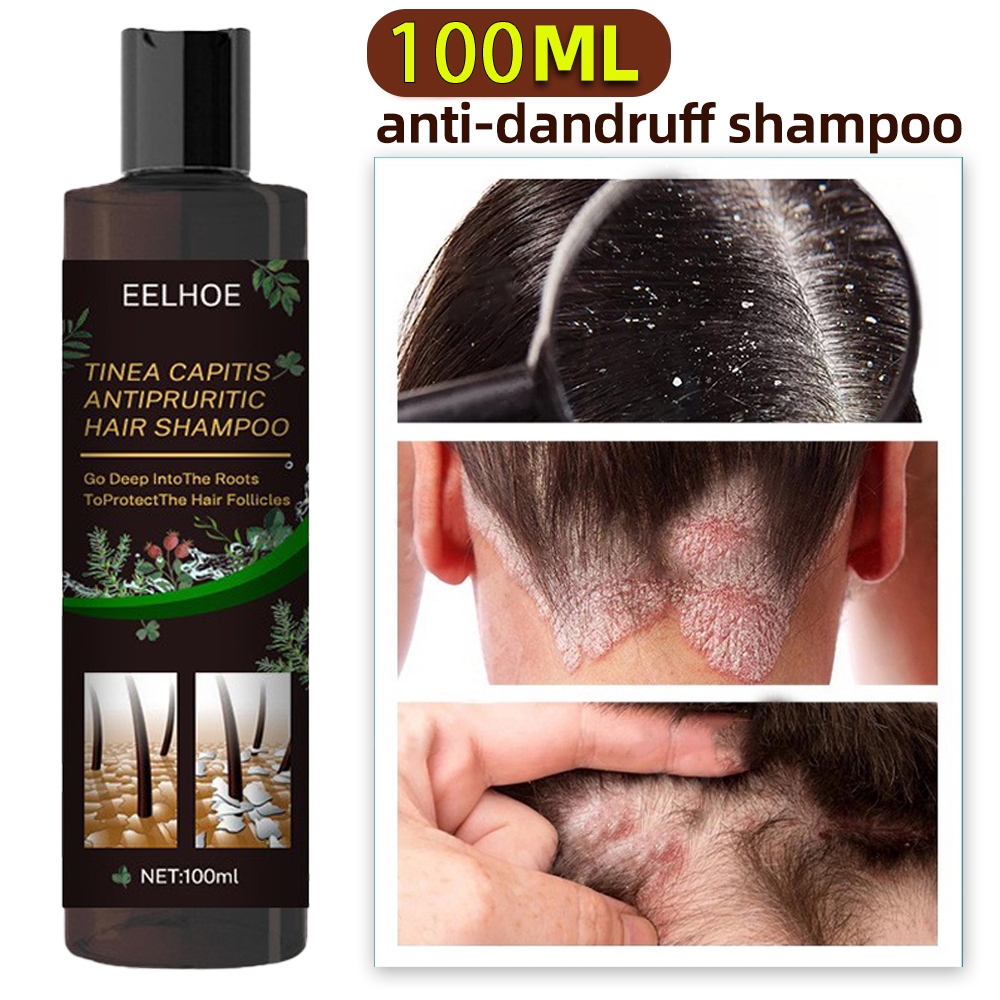 EELHOE Tinea Capitis Anti-Itch Shampoo Tinea Capitis Scalp Anti-Itch ...