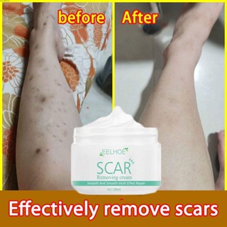 EELHOE Remove Scars Cream Leg Scar Cream 30ml Acne Scar Repair Cream Stretch Marks Burn Scar Removal Body Face Scars Skin Care. Shopee Singapore