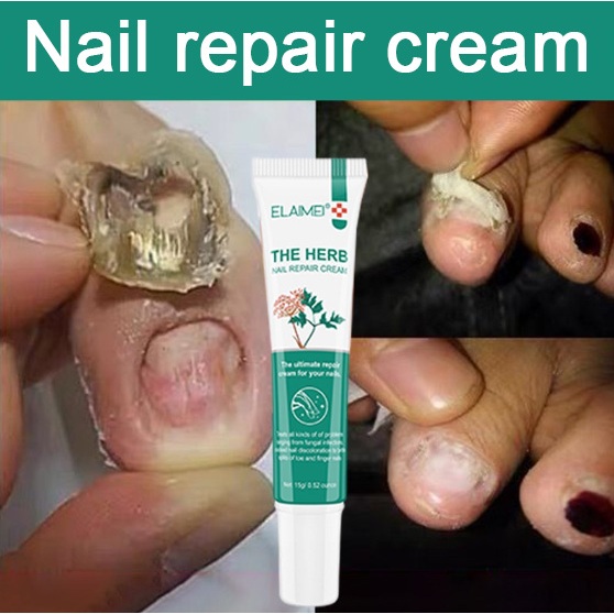 Nail Repair Cream Herbal Nail Care Cracked Nail Repair Onychomycosis ...