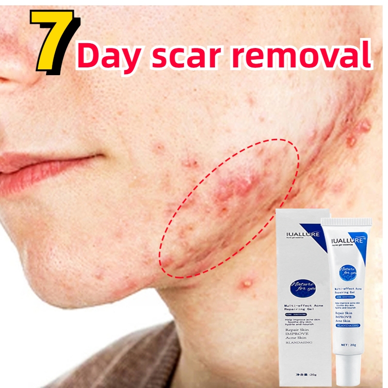 IUALLURE Acne Scar Removal Cream 20g Acne&Pimple Repair Cream Post-Acne ...