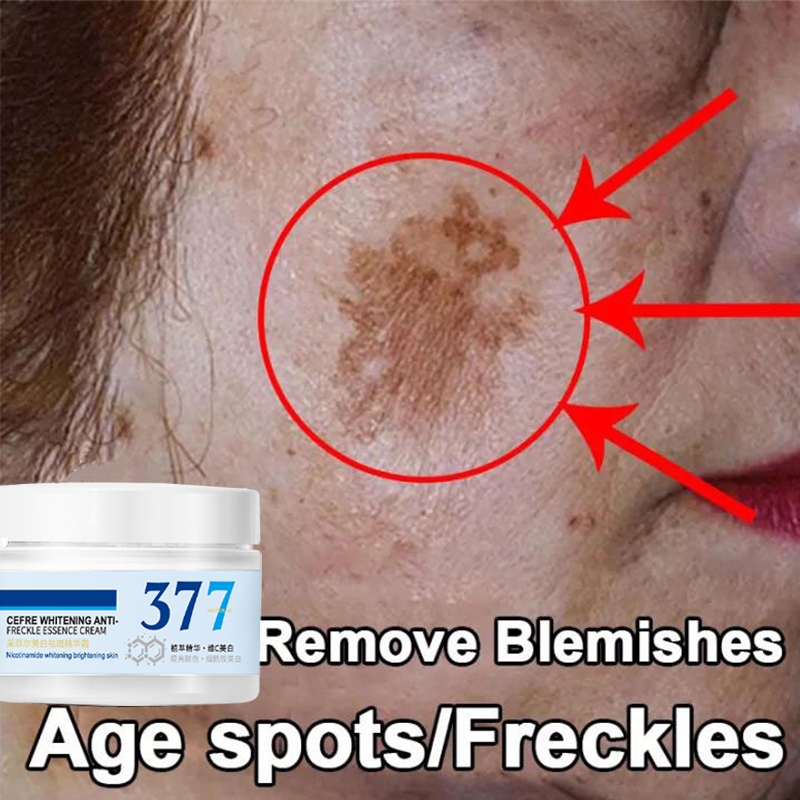 Dark Spot Remover Face Whitening Cream Freckles Removal Cream 50g ...
