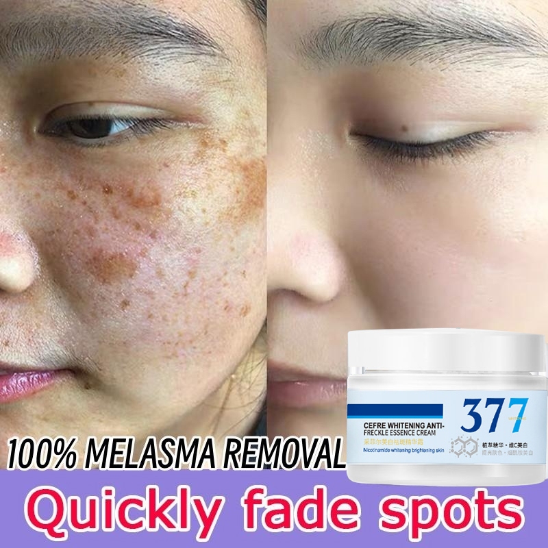 pigmentation remove cream Freckle cream 377 Whitening Cream 50ml Remove ...