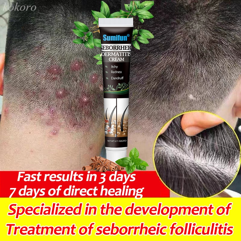 Seborrheic Folliculitis Cream,dermatitis cream,folliculitis, anti-itch ...