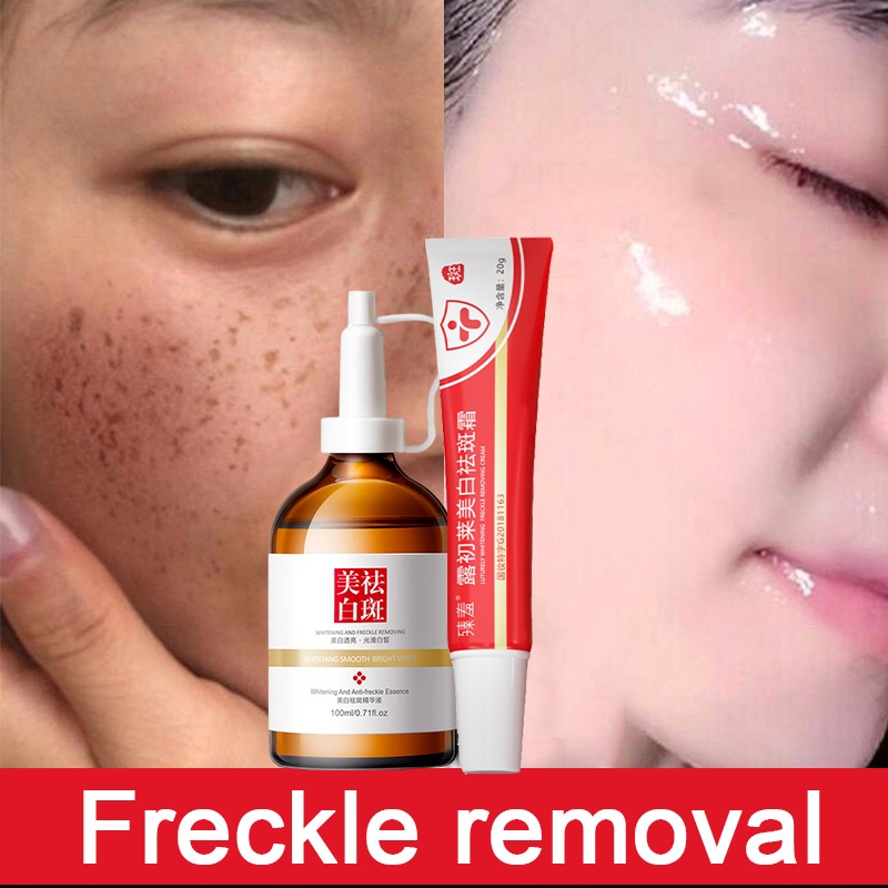 Freckle Cream Whitening and anti-freckle cream 100ml Removal Chloasma ...