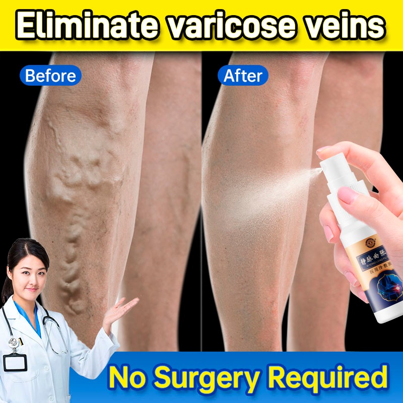 Varicose Veins Spray Varicose Veins Effective Remover Cream Varicose ...