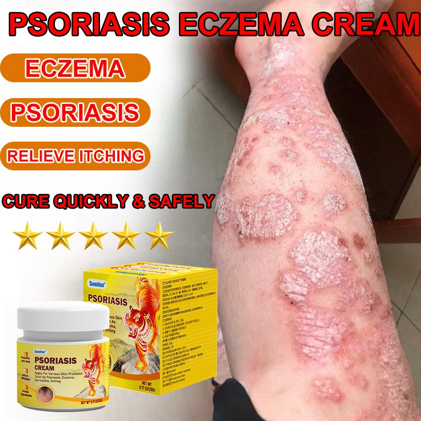 100 Herbal Formula Eczema Psoriasis Cream Antibacterial Itchy Cream