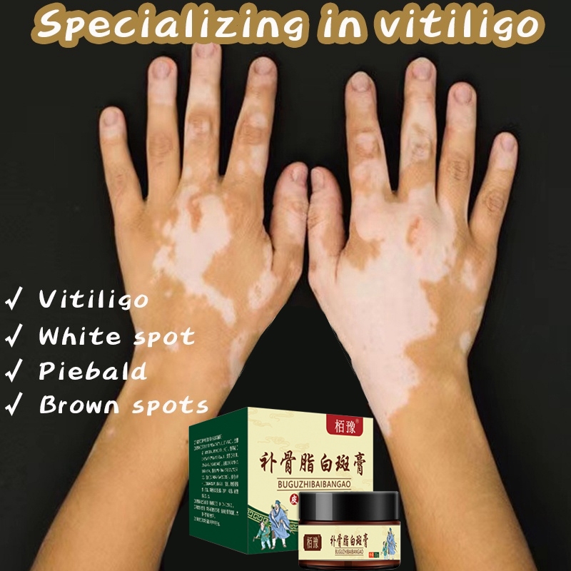Vitiligo cream vitiligo remover 20g White Spot Treatment Cream Ointment ...
