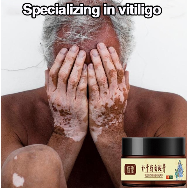 Vitiligo cream Vitiligo Treatment Cream White Spot Treatment Cream 20g ...