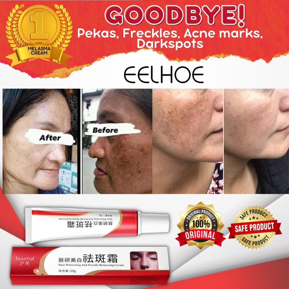 Pekas Remover Melasma Cream Anti Freckle Effective Collagen Skin ...