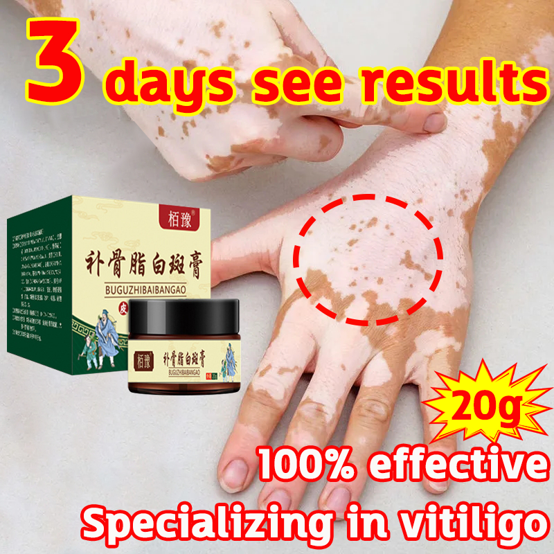 Vitiligo topical medication for removing day shift, reducing sweat ...