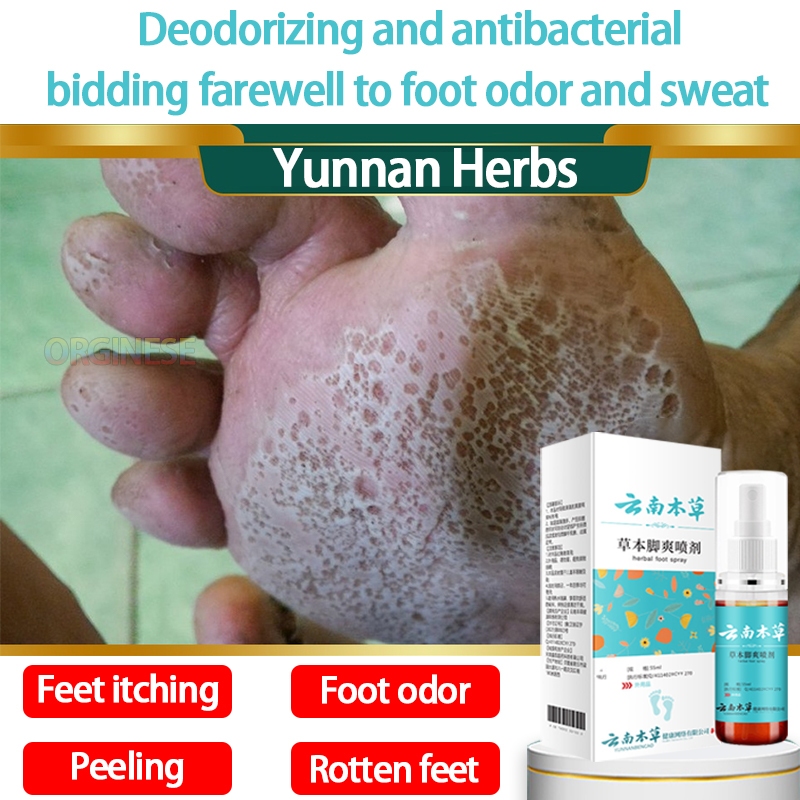 Foot Spray Foot Deodorant Foot sweat foot odor Anti fungal (of skin ...