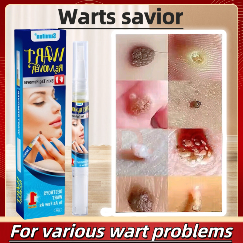 Wart removal mole remover skin tag liquid pen remove corn pellets flat ...