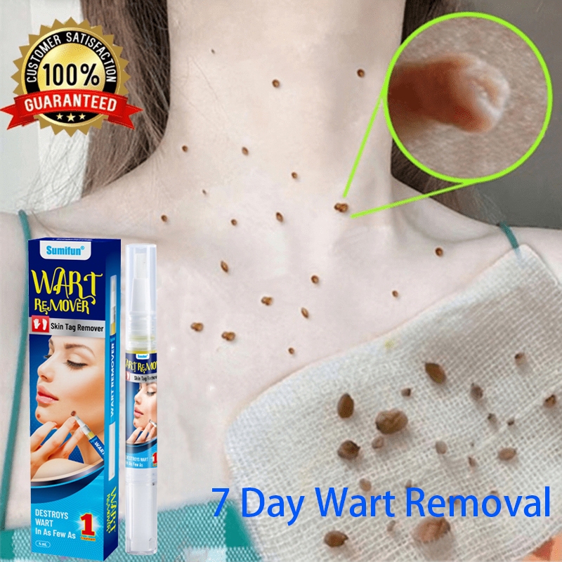 Wart Removal Pen skin tag remover pen mole remover Quickly and ...