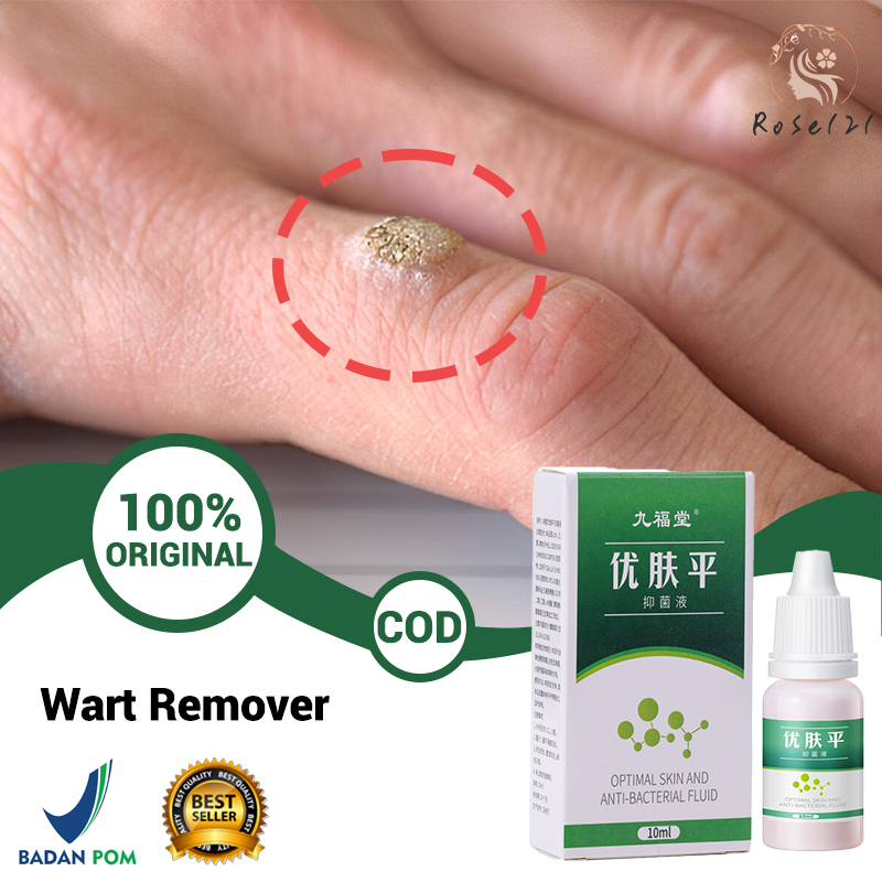 Wart Remover Cream Tag Solution Skin Tag Skin Tag Mole Wart Removal ...