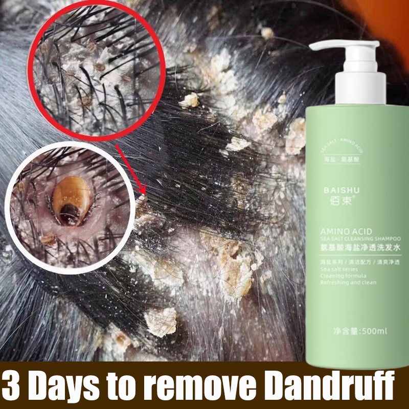 anti dandruff shampoo dandruff scalp treatment 500ml psoriasis Reduce ...