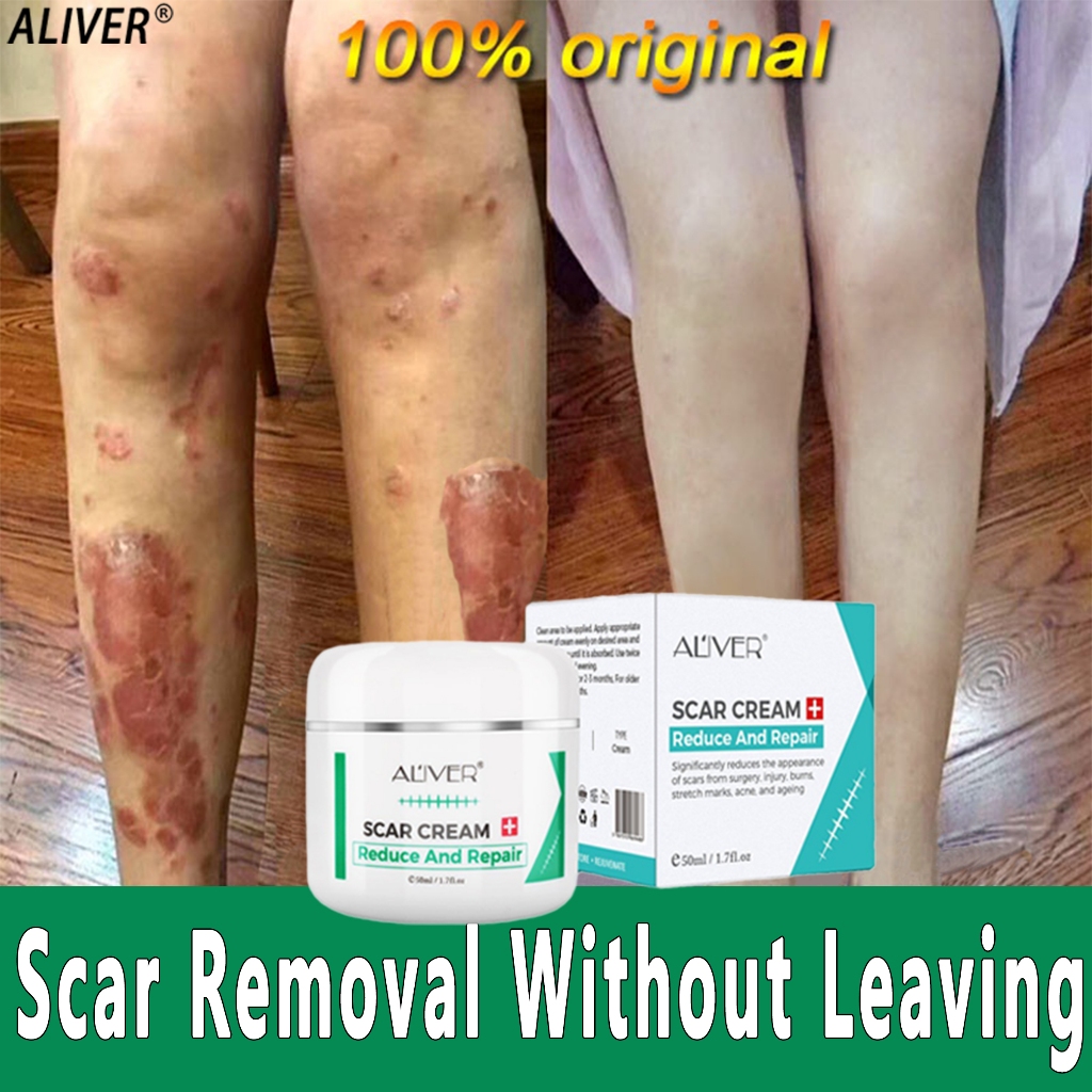 ALIVER Natural Herbal Scar Remover Cream，Skin Repairing Cream，50ml ...